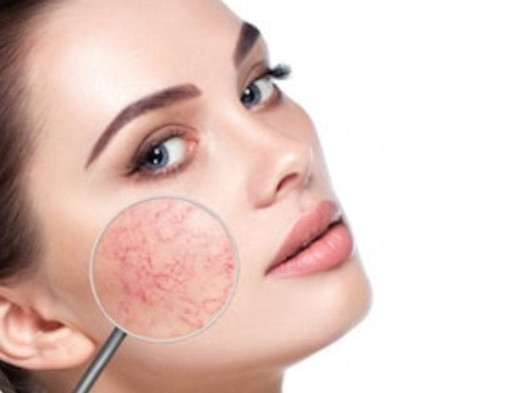 Comment atténuer l'angiome rubis sans Laser ? - OLEASSENCE en Luberon